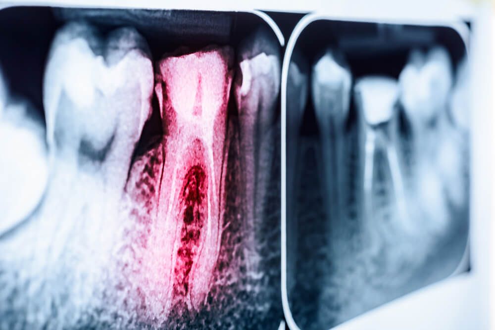 Traumatic Injuries - Newlin Endodontics
